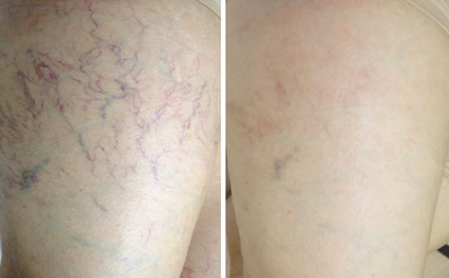 Traitement des varicosités à Créteil dans le Val de Marne (94)